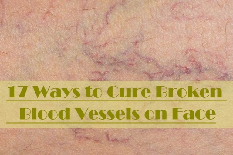 17 Home Remedies to Cure Broken Blood Vessels on Face