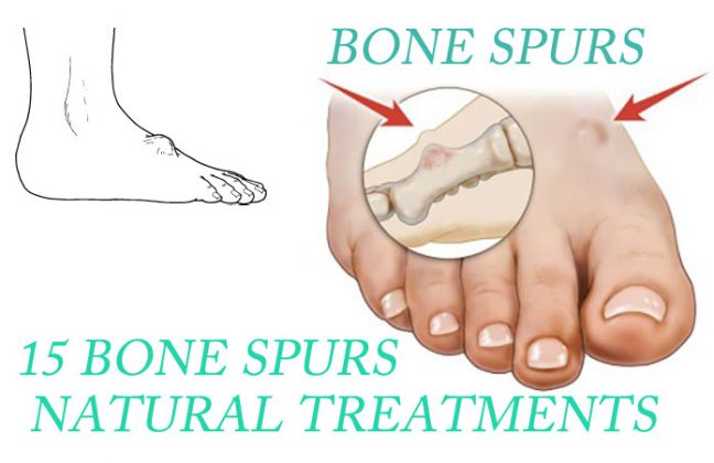 15 Bone Spurs (Neck And Knee) Natural Treatments That Work