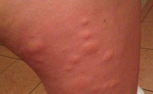 11 Effective Home Remedies To Get Rid Of Sand Fleas Infestation