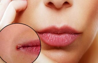 12 Home Remedies to Heal Cracked Lip Corners Fast that Really Work